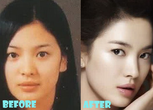 Song Hye Kyo Plastic Surgery Nose Job - Lovely Surgery | Celebrity ... Song Hye Kyo Plastic Surgery Nose Job - Lovely Surgery | Celebrity ...